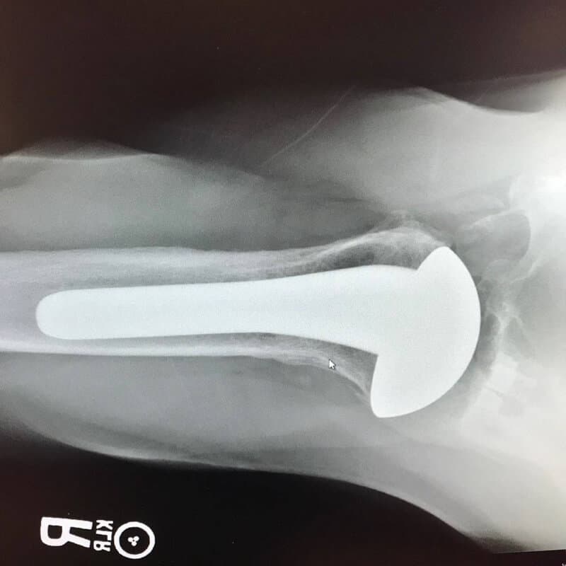 Exactech, Cage Glenoid - American Shoulder and Elbow Surgeons