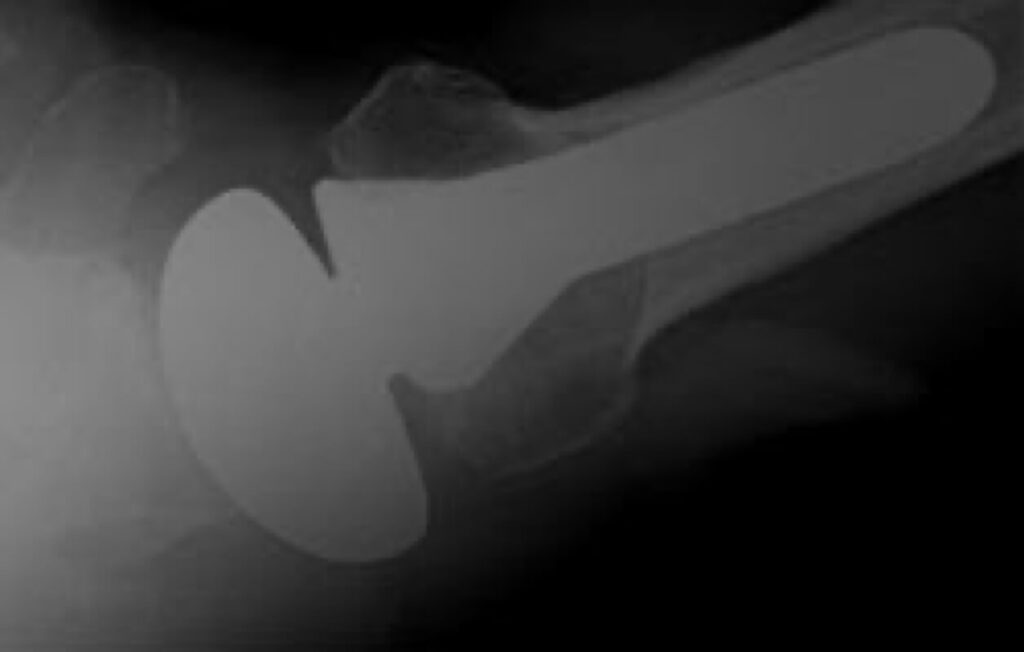Stryker/Wright/Tornier, Solar Bipolar - American Shoulder and Elbow ...