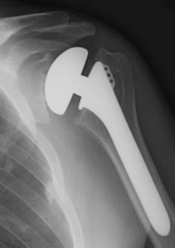 Stryker/Wright/Tornier, Solar Bipolar - American Shoulder and Elbow ...