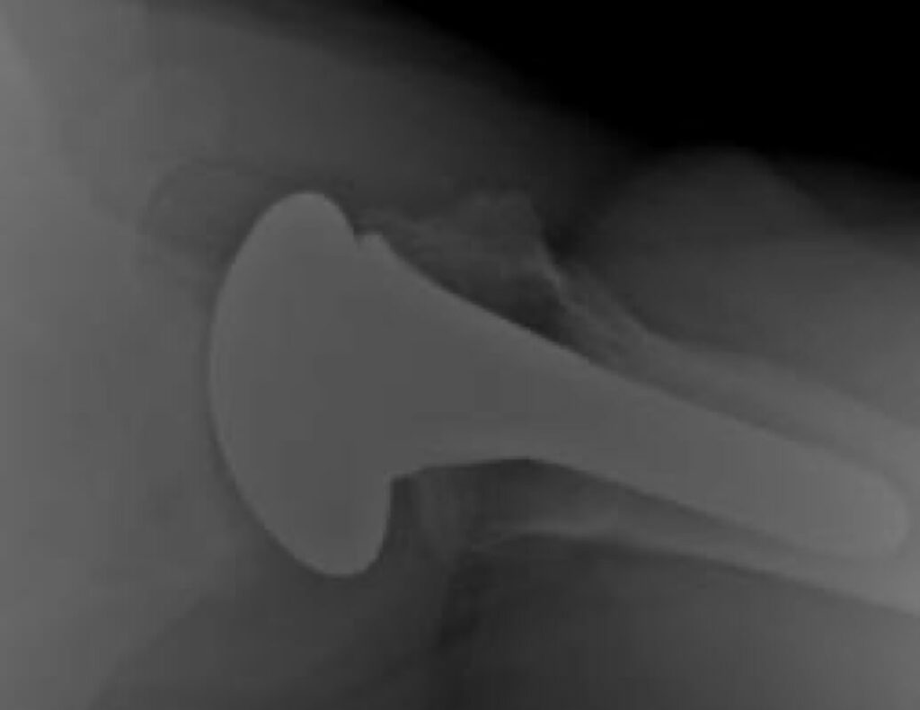 Stryker/Wright/Tornier, Solar Offset - American Shoulder and Elbow Surgeons