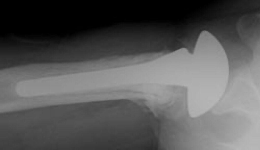 DePuy, Global Fracture - American Shoulder and Elbow Surgeons