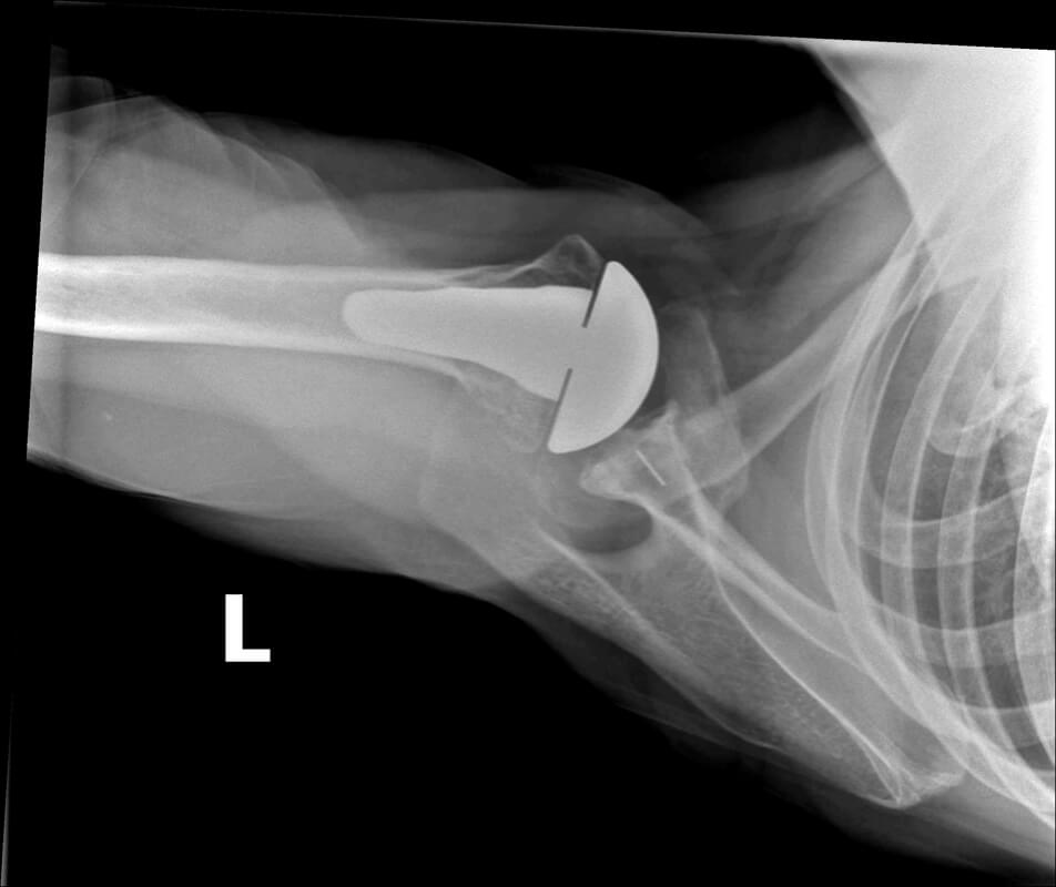 Stryker/Wright/Tornier, Ascend Flex - American Shoulder and Elbow Surgeons