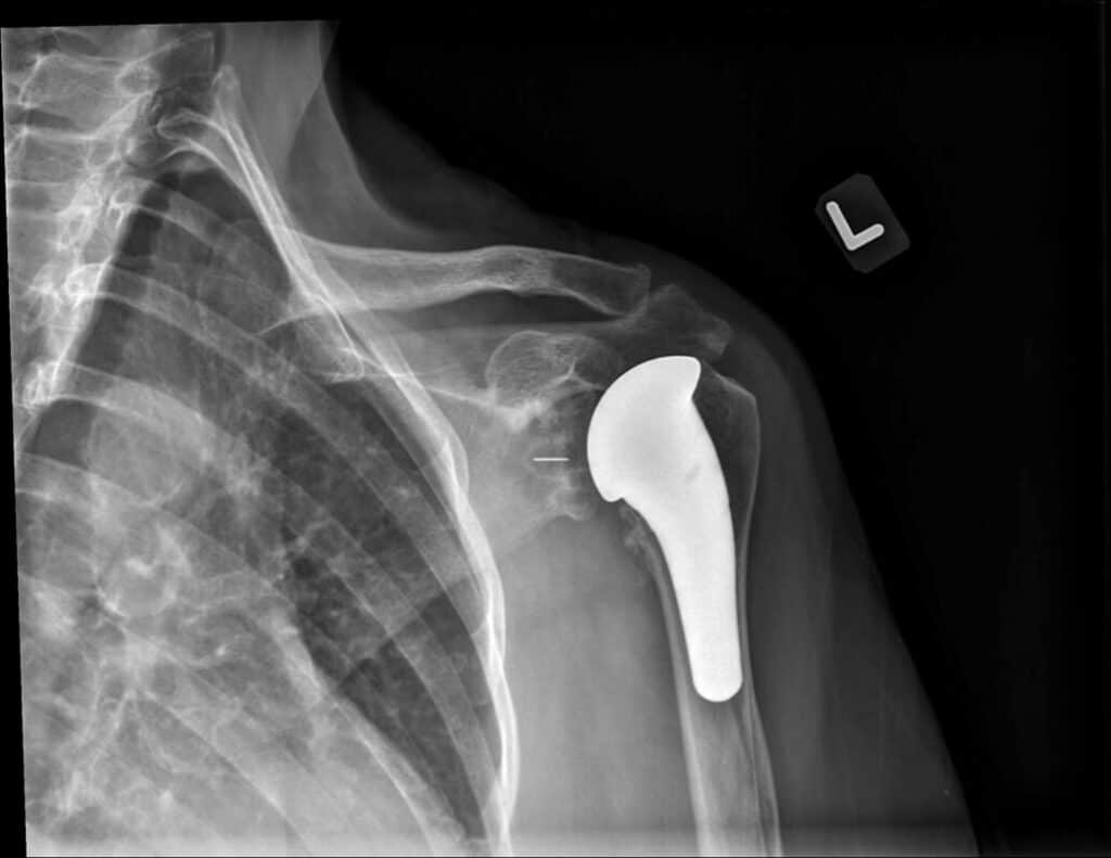 Stryker/Wright/Tornier, Ascend Flex - American Shoulder and Elbow Surgeons