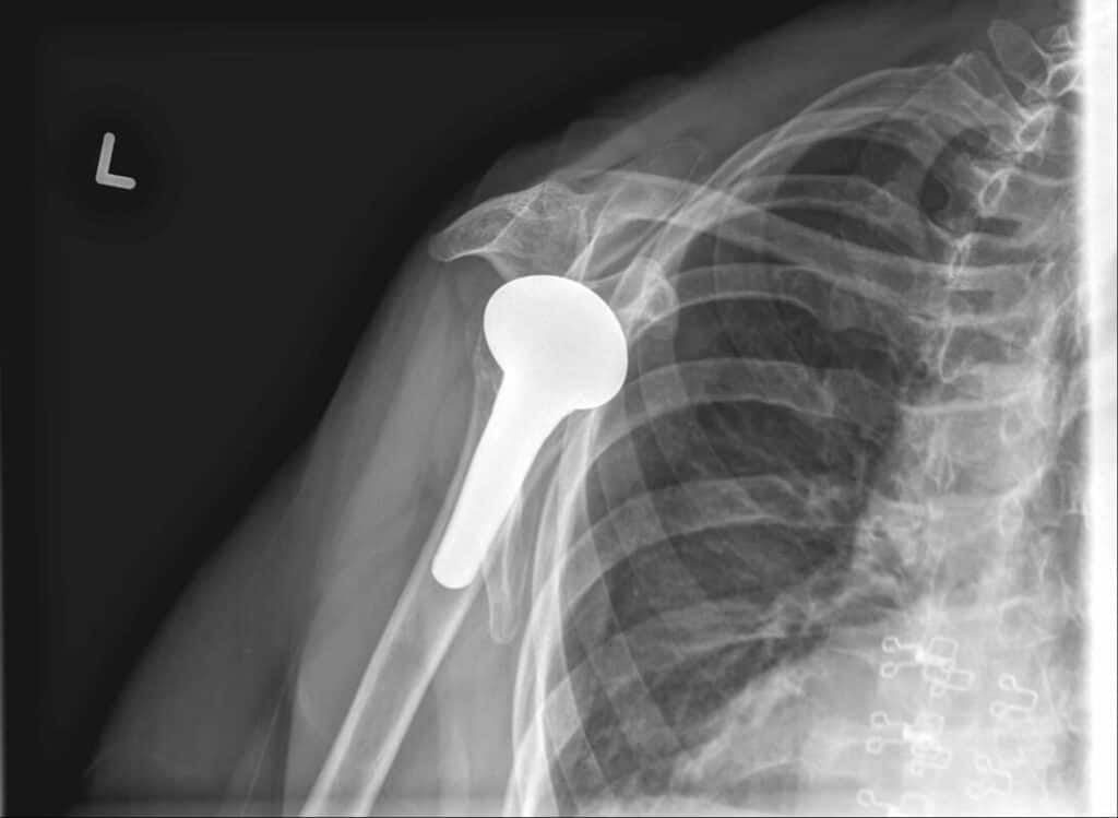 Stryker/Wright/Tornier, Ascend Flex - American Shoulder and Elbow Surgeons